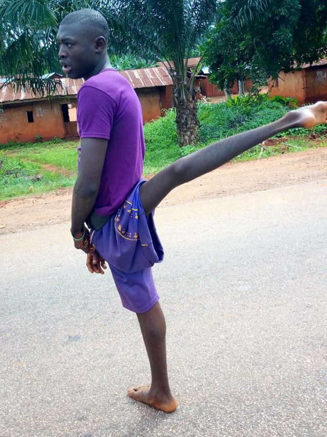 Young Man Whose One Leg Is Always Up Due To Rare Medical Condition Young Man Whose One Leg Is Always Up Due To Rare Medical Condition